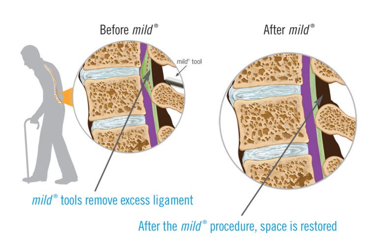 Minimally Invasive Lumbar Decompression Surgery in Kansas City