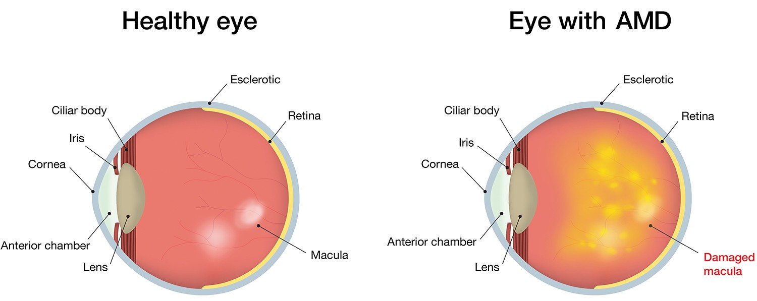 A Clear View of Common Retinal Diseases Affecting Vision - Healthy ...