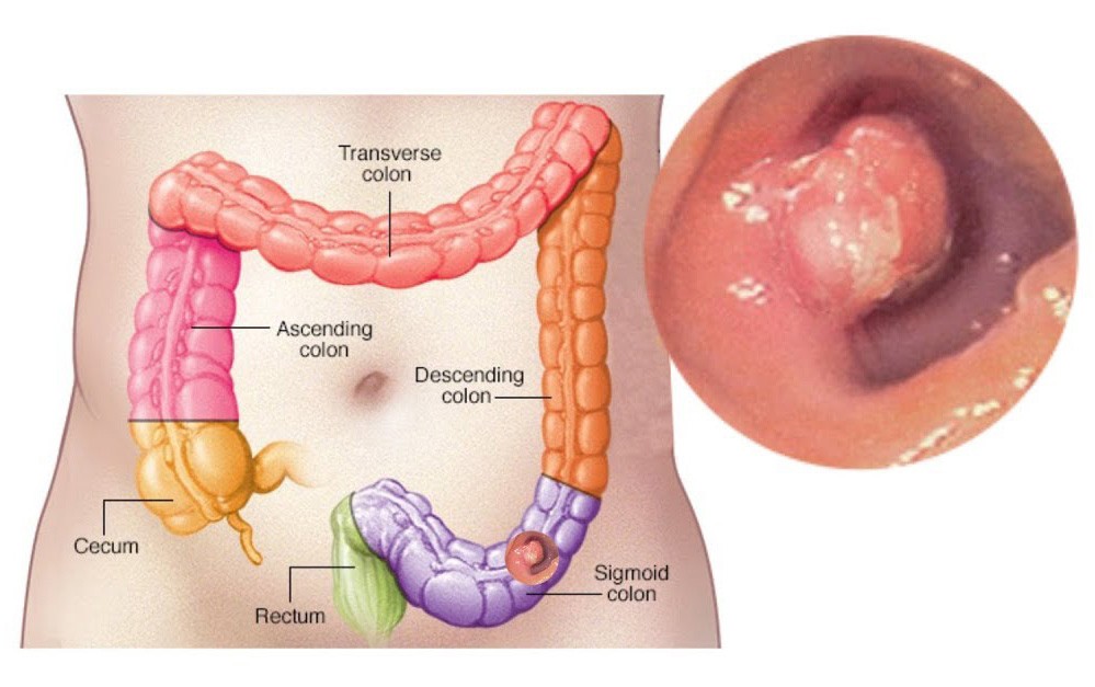 Colorectal Cancer Healthy Kansas City