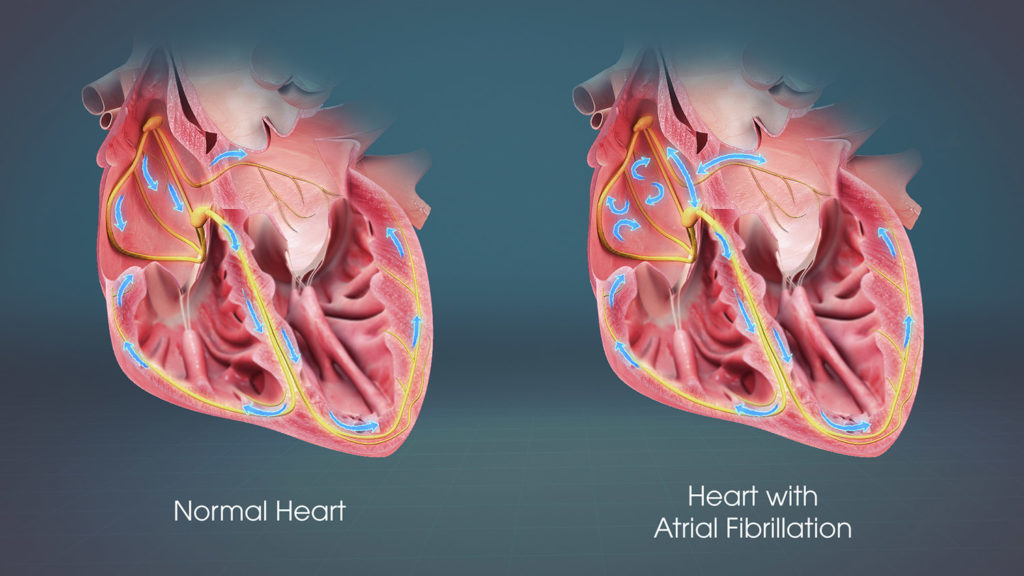 Atrial Fibrillation Awareness Is More Important Than Ever - Healthy ...